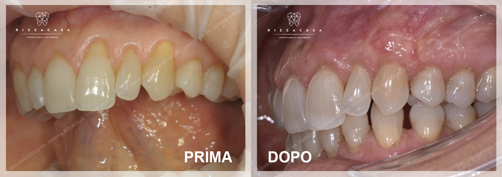 Malattia Parodontale Prima E Dopo Le Foto PARODONTOLOGIA