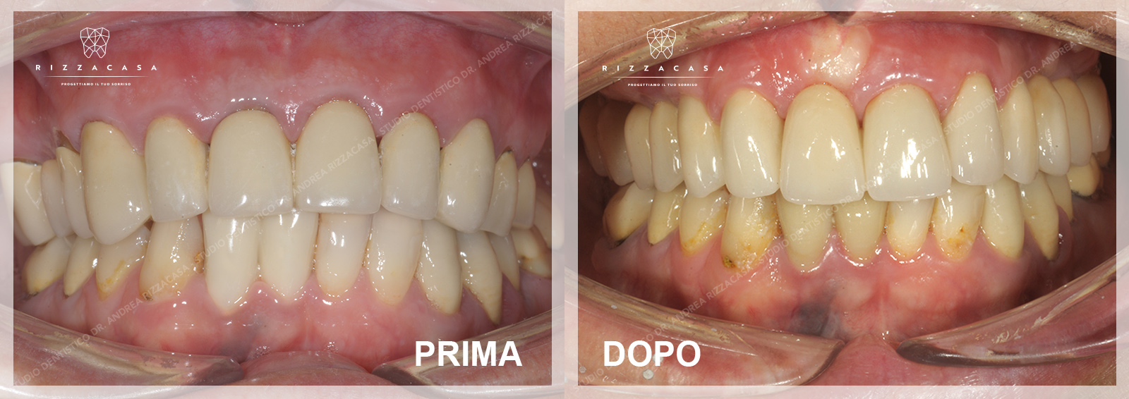 Corone in zirconio e in ceramica Monza e Brianza - Studio Dentistico ...