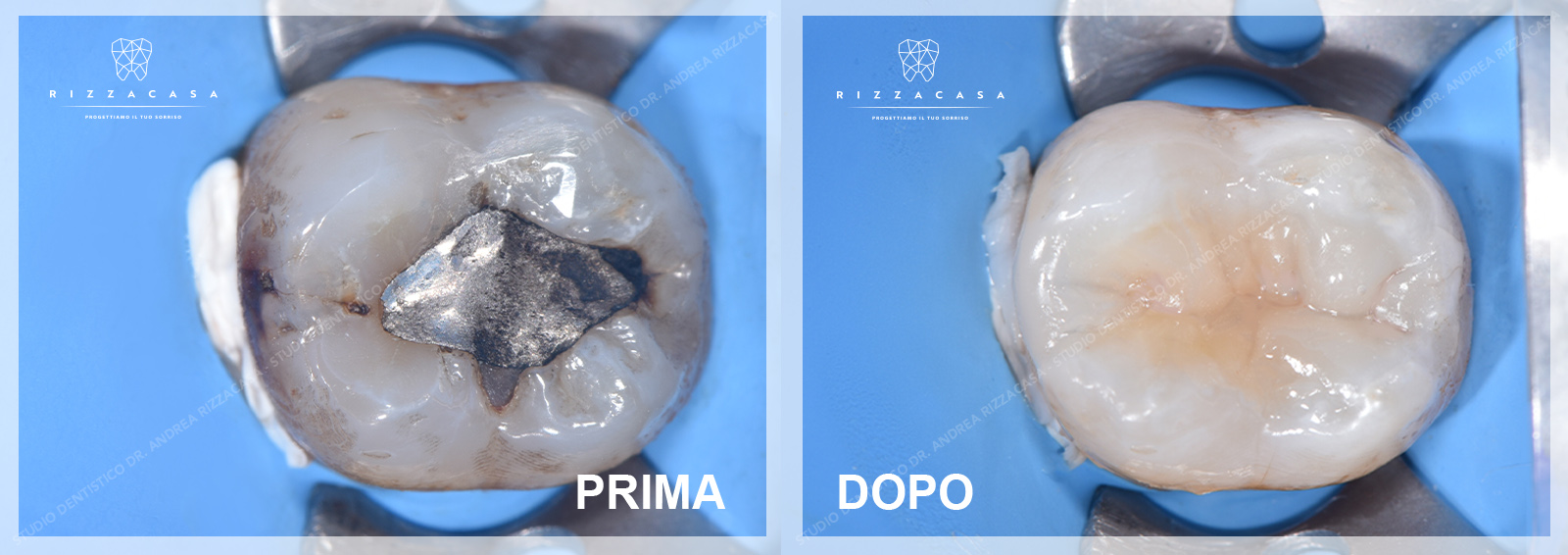 Intarsio Dentale Monza e Brianza - Studio Dentistico Rizzacasa