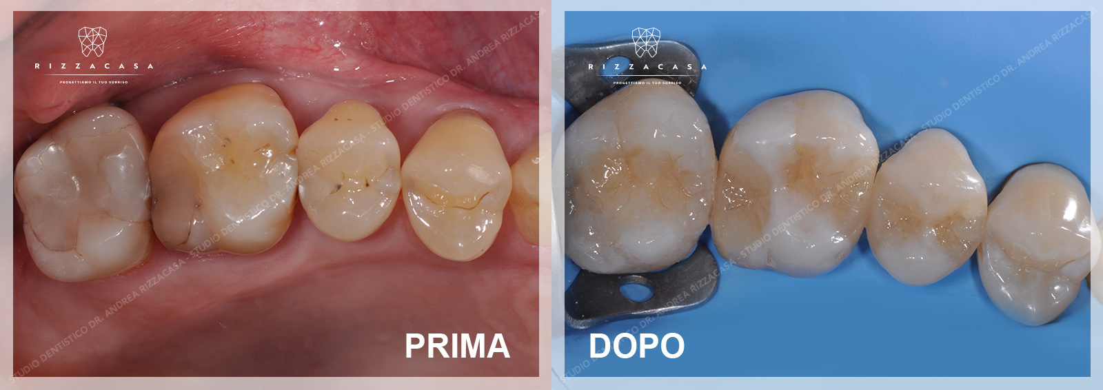Intarsio Dentale Monza e Brianza - Studio Dentistico Rizzacasa