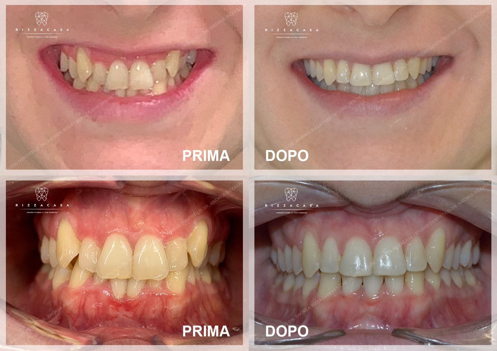 Apparecchio denti - Ortodonzia Invisalign Monza e Brianza - Studio ...
