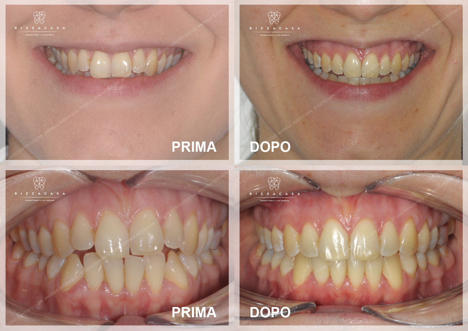 Apparecchio denti - Ortodonzia Invisalign Monza e Brianza - Studio ...